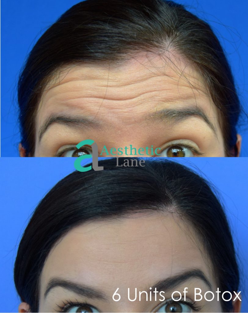 Botox Brow Lift: Before & After Photos, Cost & Benefits - Aesthetic Lane